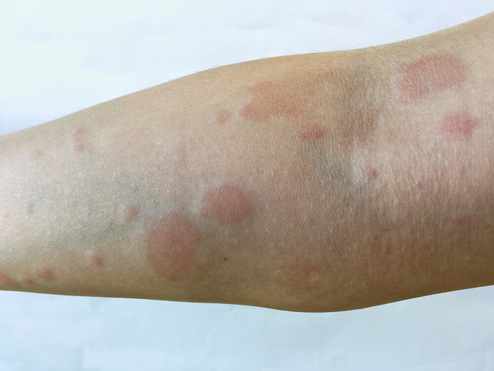 Lúpus: o que é, sintomas, diagnóstico e tratamento com CBD